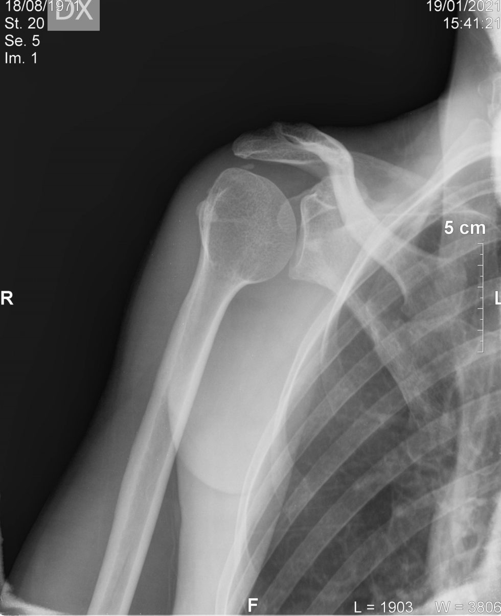 TENDINOPATIA CALCIFICA, COME RICONOSCERLA E TRATTARLA? - Fisiosalus Perugia